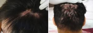 Acne Necrotica - Dr. V. Kharangate